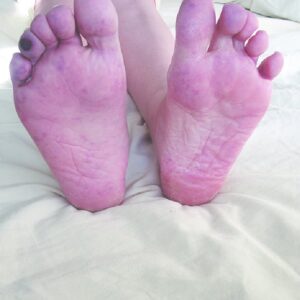 Blue Toe Syndrome - Dr Qaisar Ahmed MD, DHMS