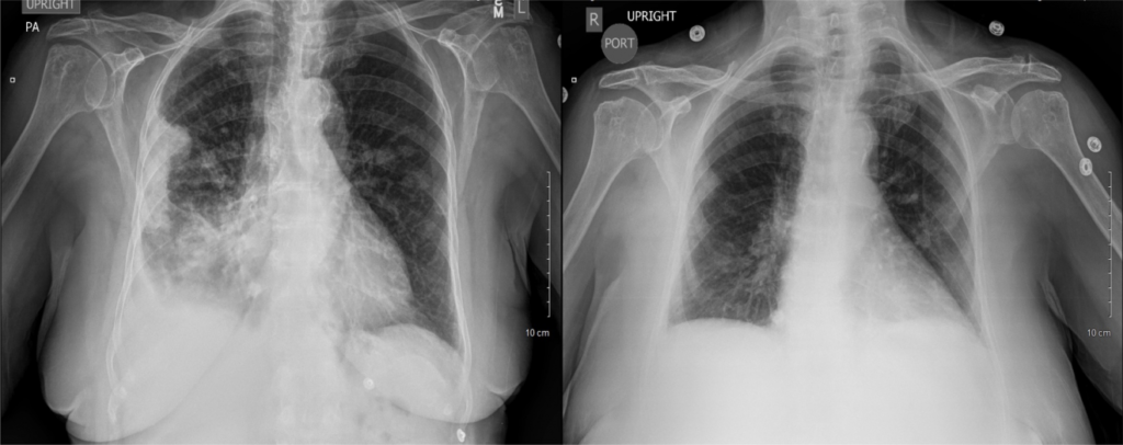 Malignant Mesothelioma - Dr Qaisar Ahmed MD, DHMS