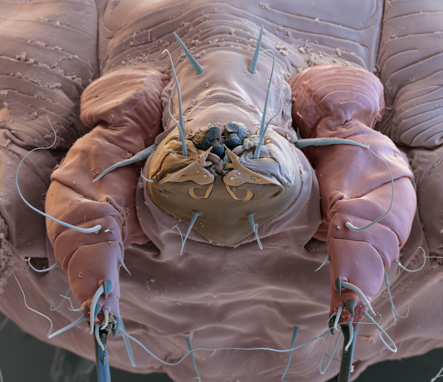 Scabies - Best Treatment Optins by Dr Qaisar Ahmed MD, DHMS