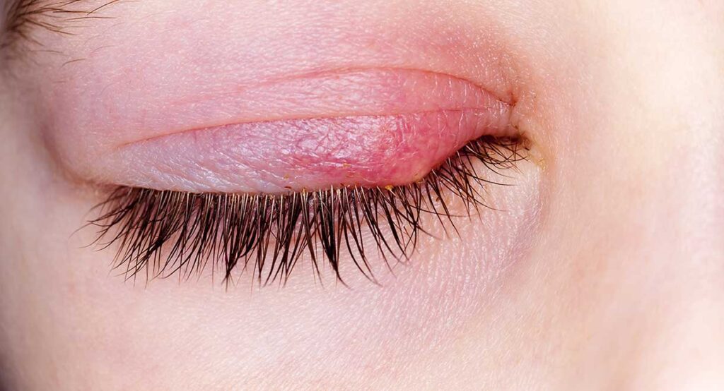 Blepharitis | Dr Qaisar Ahmed MD, DHMS | Top | Best | Homeopathic ...