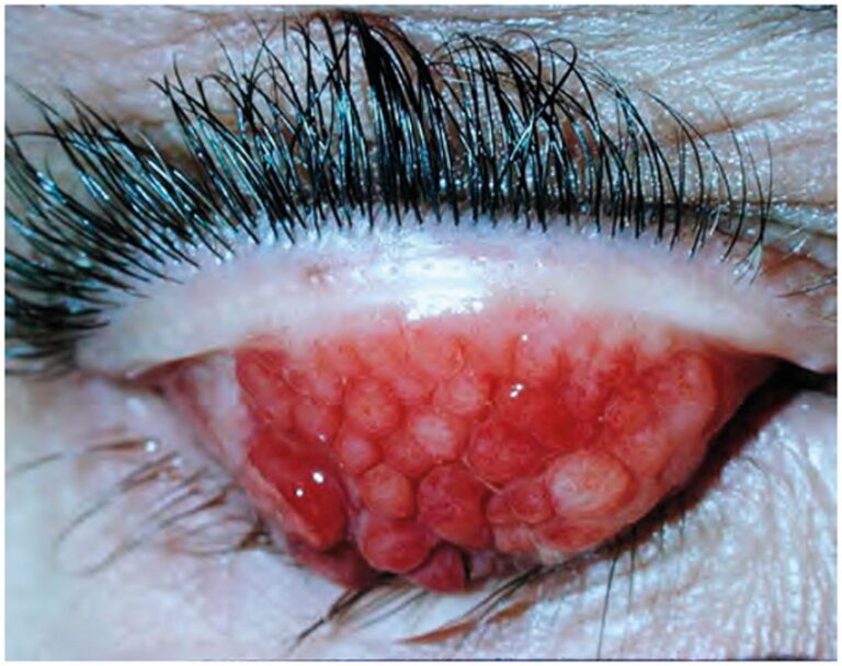 Giant Papillary Conjunctivitis - Dr Qaisar Ahmed MD, DHMS