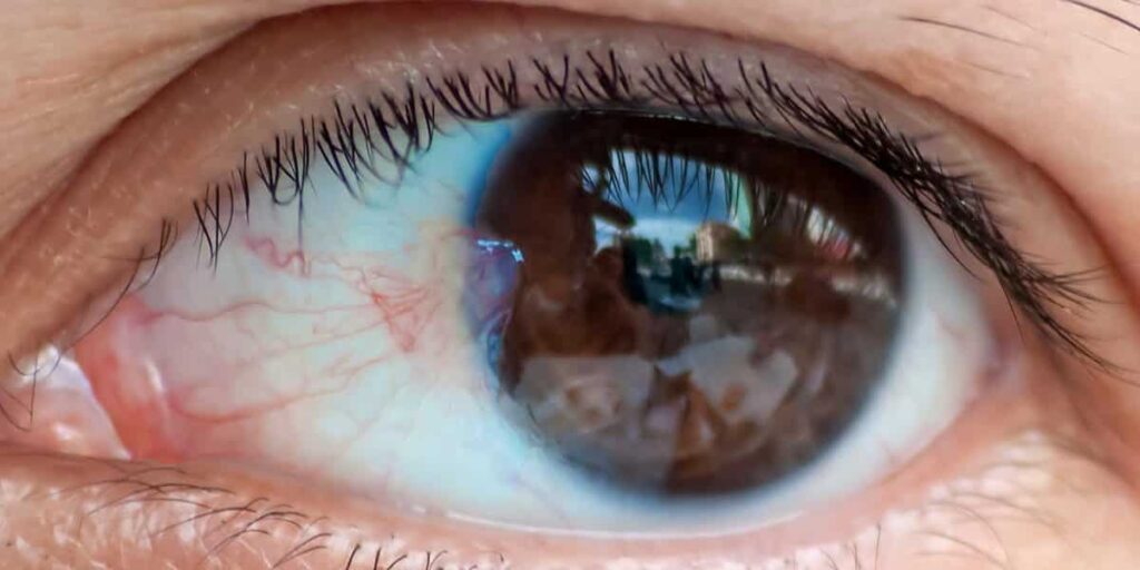 Pinguecula Eye growth | Dr Qaisar Ahmed MD, DHMS | Best | Homeopathic ...