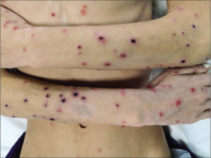 Syphilis - Symptoms, Diagnosis, Allopathic & Homeopathic Aproach Dr ...